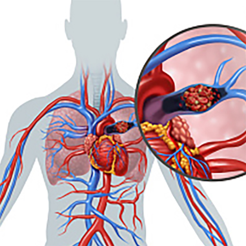 ¿El riesgo de muerte en las personas con embolia pulmonar depende del ...
